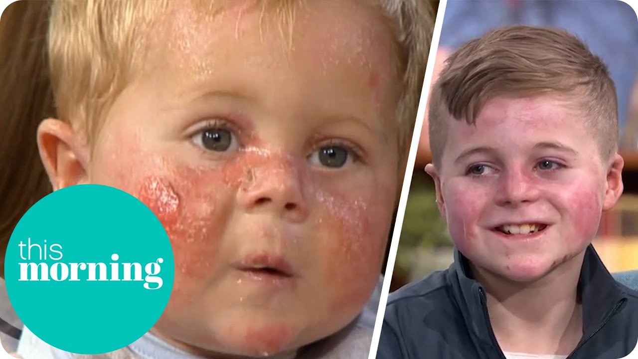 Boy With 'Butterfly' Skin Returns 10 Years Later To Show Eamonn His ...