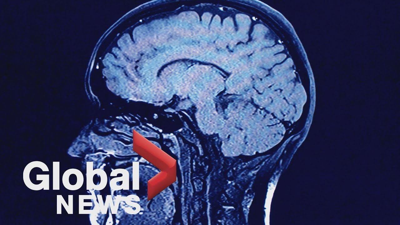 Investigating New Brunswick's mysterious, fatal brain disease - The ...