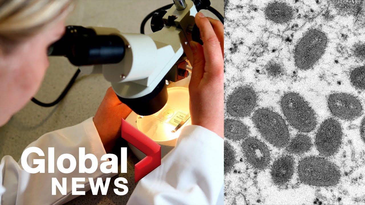 Health officials urge calm as more monkeypox cases emerge in Canada ...