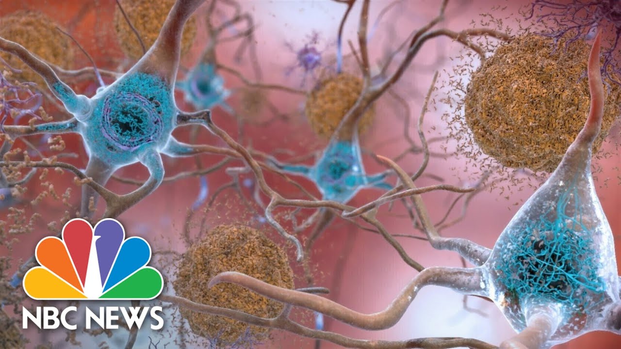 New Alzheimer’s Drug Could Signal Potential Treatment Breakthrough ...