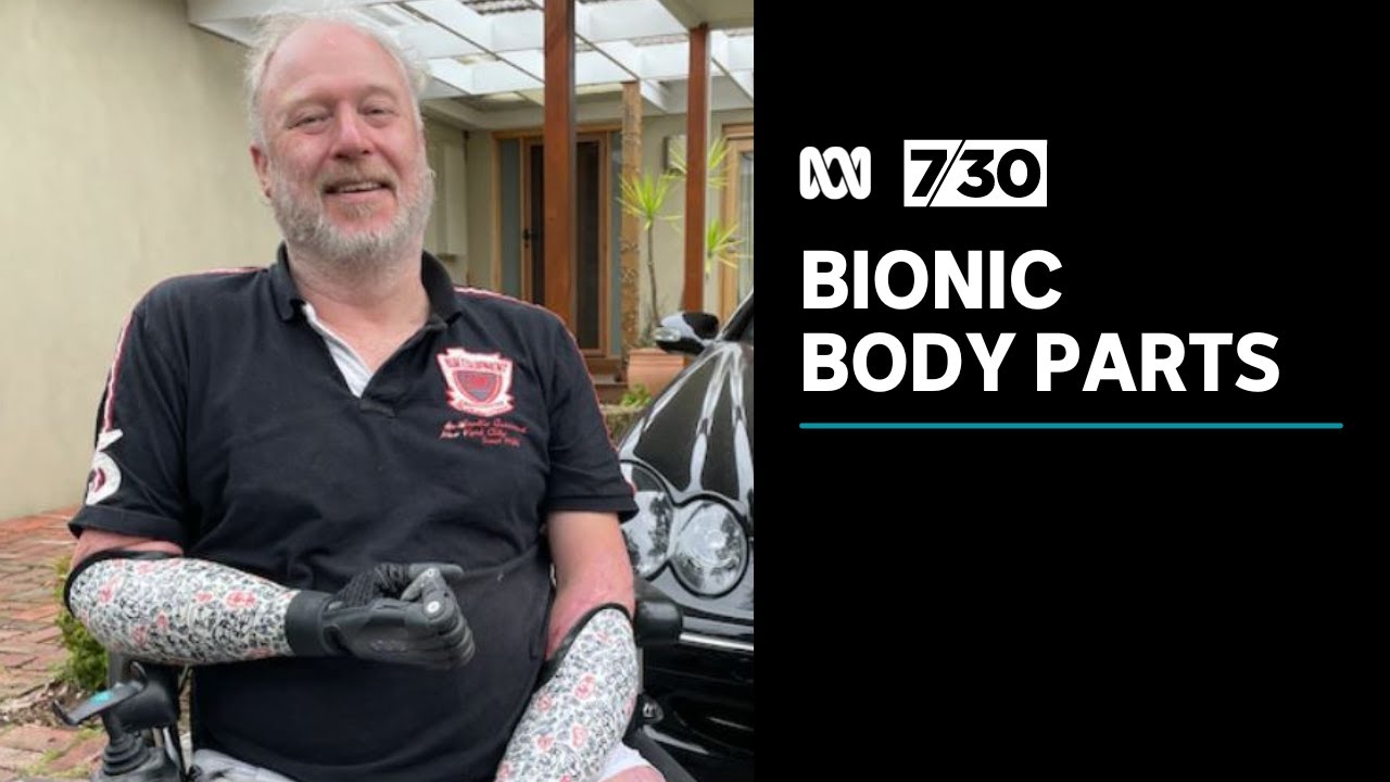 John lost all his limbs four years ago. Bionic devices let him return ...