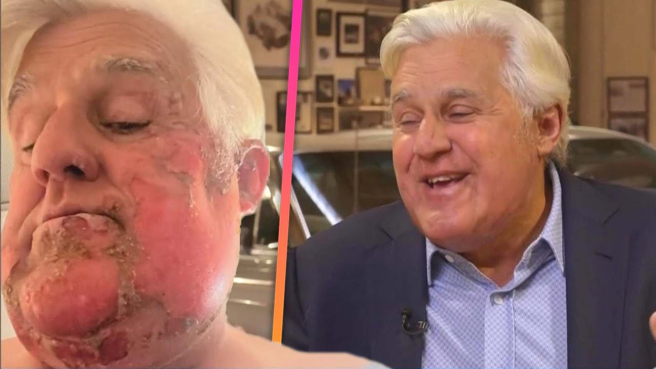 Jay Leno Says His Face Caught Fire in First Interview After Burn ...