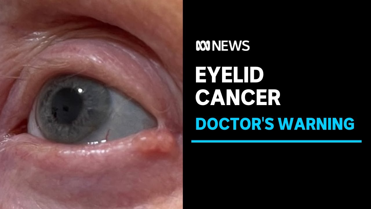 Gold Coast man was 'very close' to losing his eye to skin cancer | ABC ...