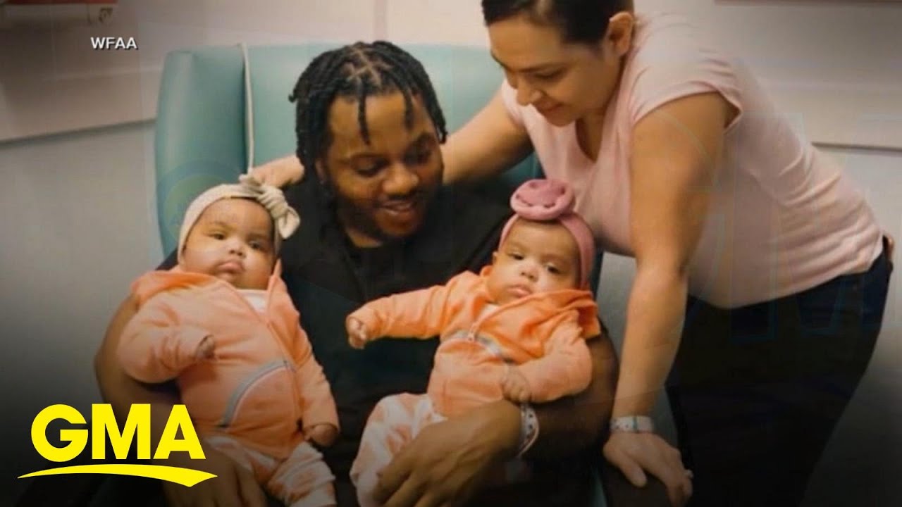 Formerly conjoined twins celebrate homecoming l GMA - The Global Herald