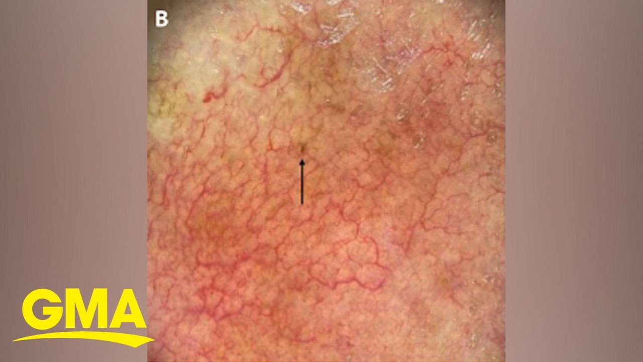 Dermatologists discover world's smallest skin cancer l GMA - The Global ...