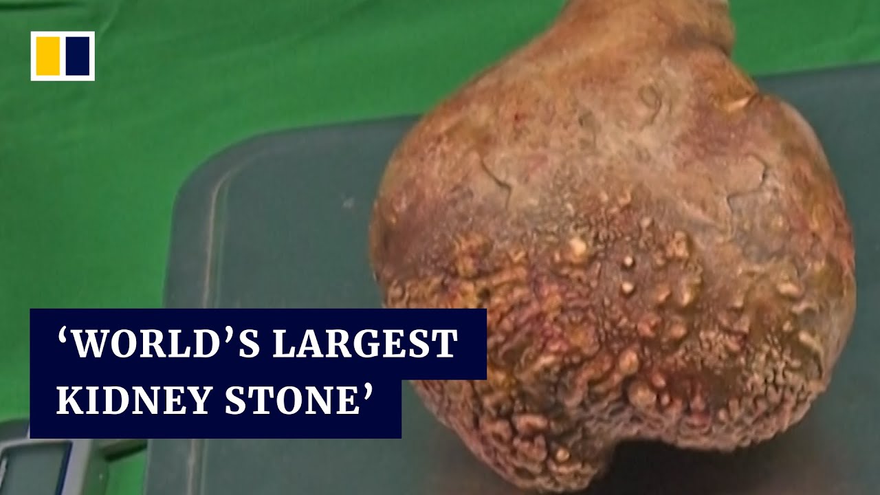 Sri Lankan army doctors remove world's largest kidney stone, setting ...