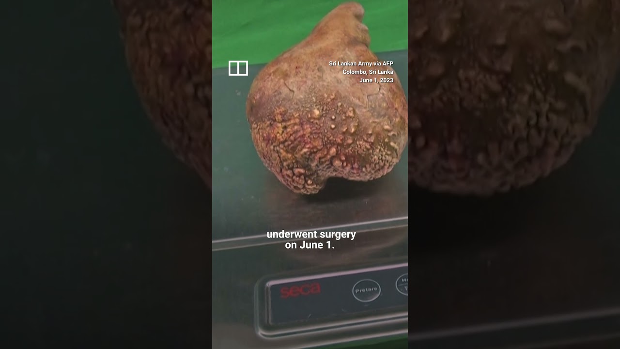 IN A MINUTE: Sri Lanka doctors remove 'world's-largest kidney stone' # ...