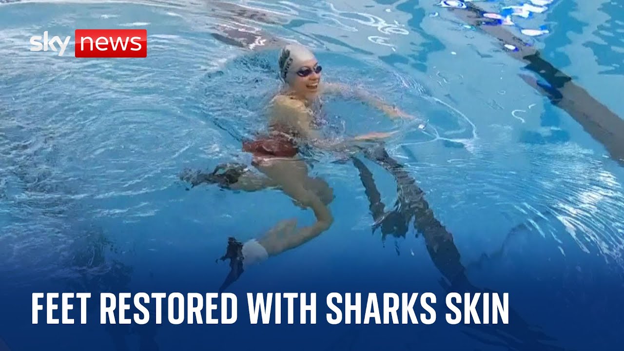 Swimmer's feet restored with shark cartilage and skin after being ...