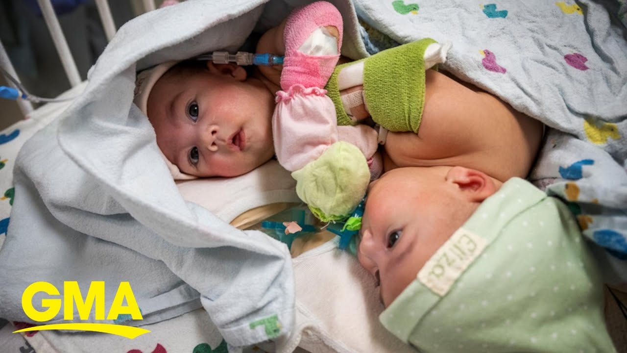Formerly conjoined twins go home from hospital after 6-hour surgery ...