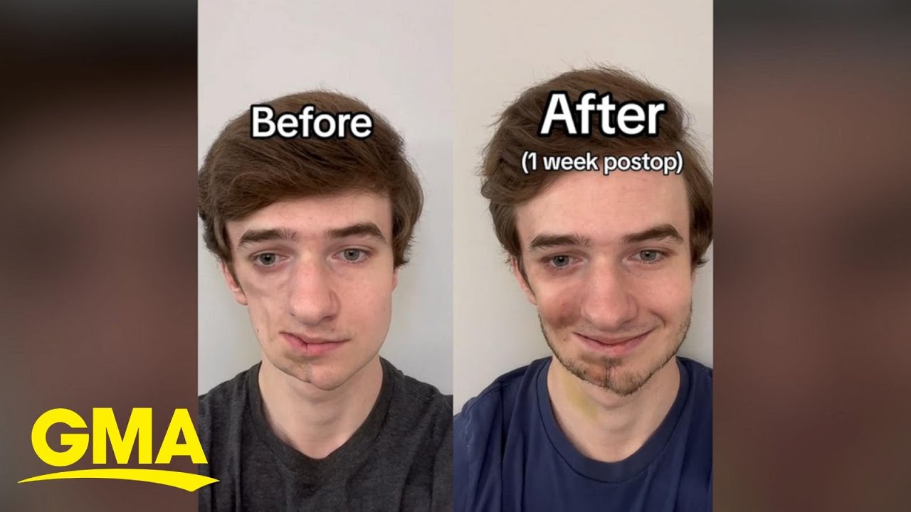 Teen documents life with rare facial disorder, raises awareness to ...