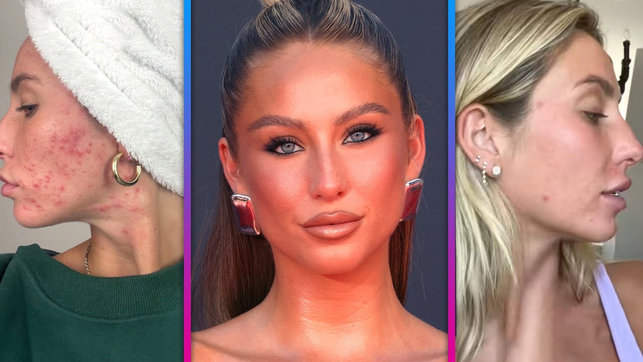 Alix Earle Says Acne Struggles Were So Bad She Wouldn't Leave Her House ...