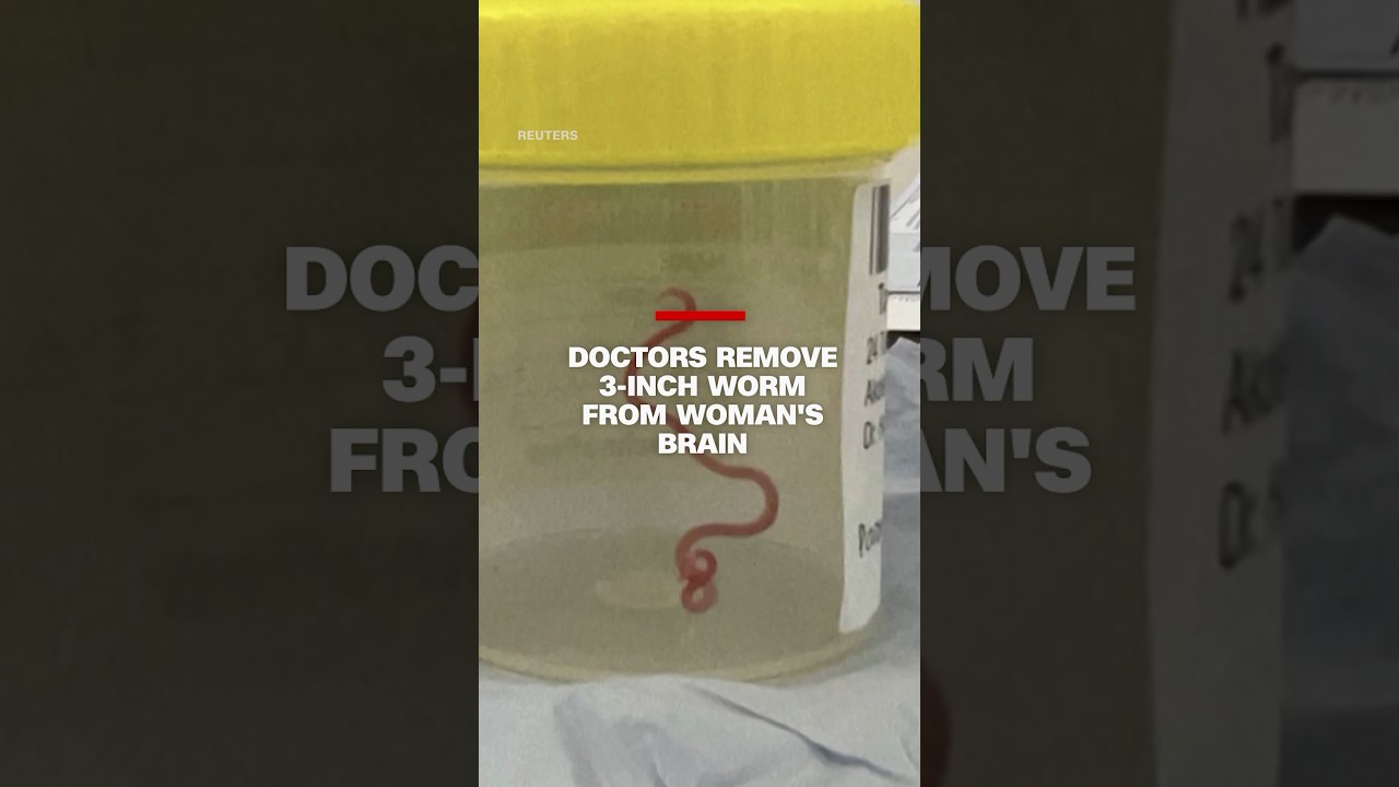 Worm removed from woman's brain - The Global Herald