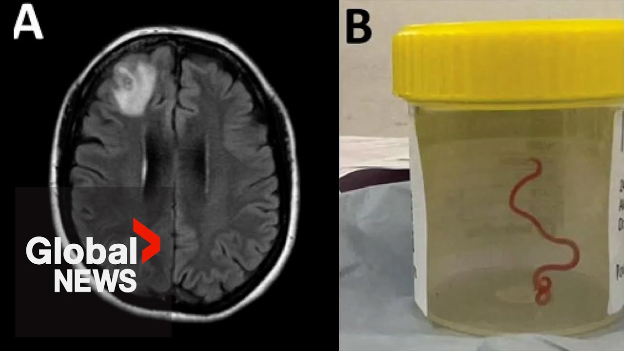 Doctors pull wriggling 8-centimetre live worm from patient’s brain ...