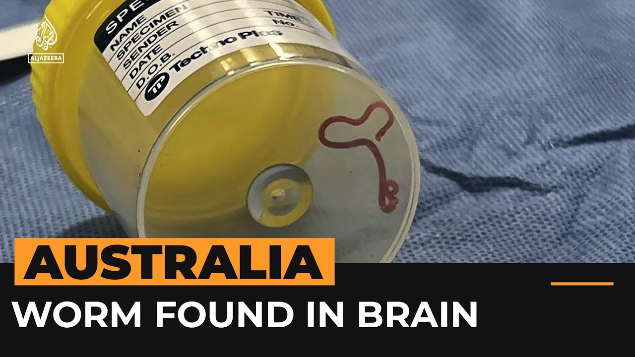 Doctors find live worm in Australian woman's brain | Al Jazeera ...