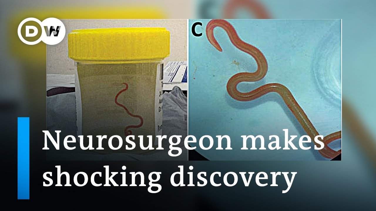 Neurosurgeon removes live worm from woman's brain in world-first ...