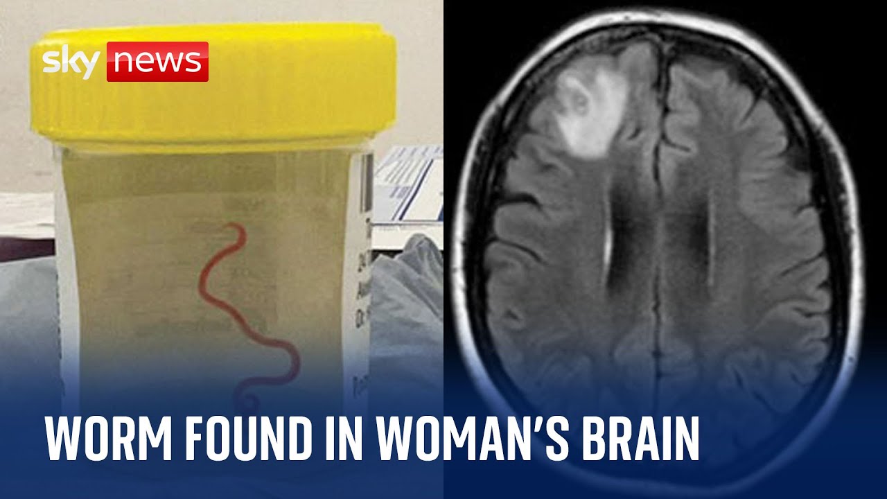 Live worm found in woman's brain in world-first discovery - The Global ...