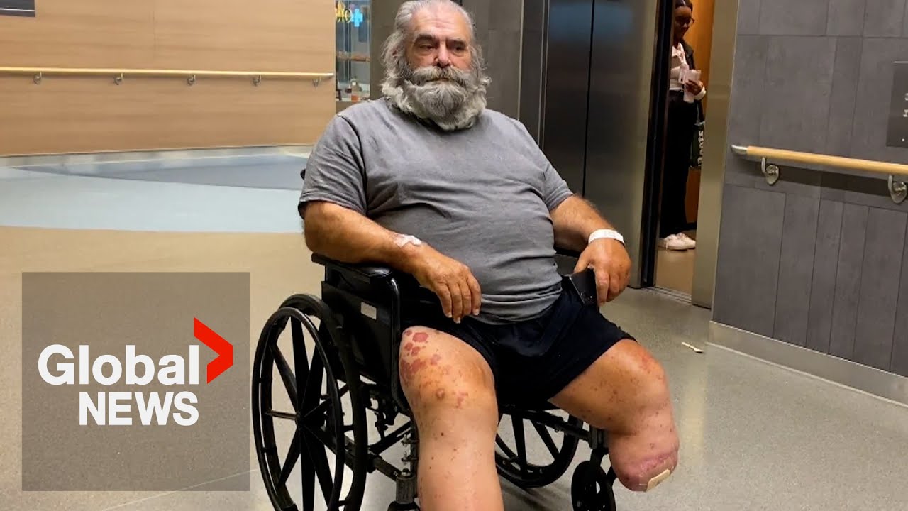 Homeless amputee in Ontario on verge of losing 2nd leg - The Global Herald