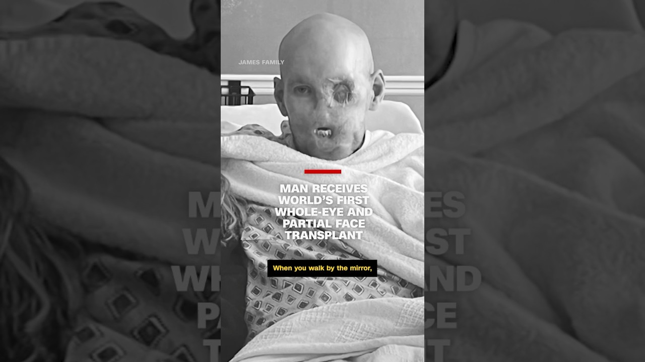 Man receives world's first whole-eye and partial face transplant - The ...