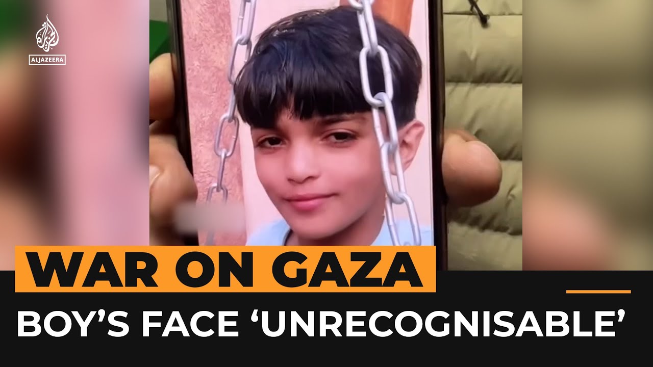 Injured Palestinian boy in Gaza no longer recognises his own face | Al ...