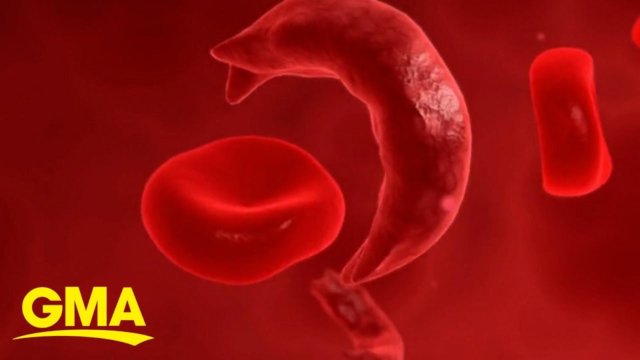 FDA approves 2 breakthrough treatments for those living with sickle ...