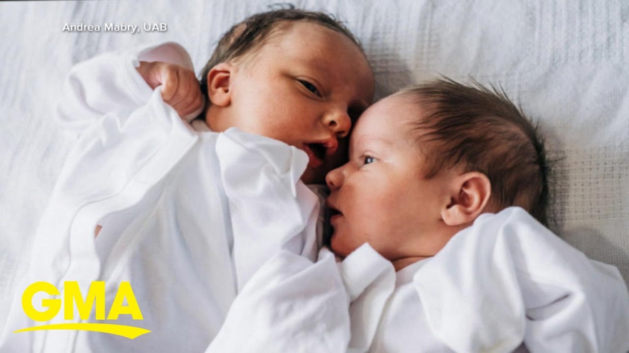 Meet twins born from '1 in a million' pregnancy - The Global Herald